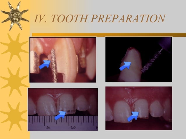 Iv.tooth prep v. occlusion | PPT
