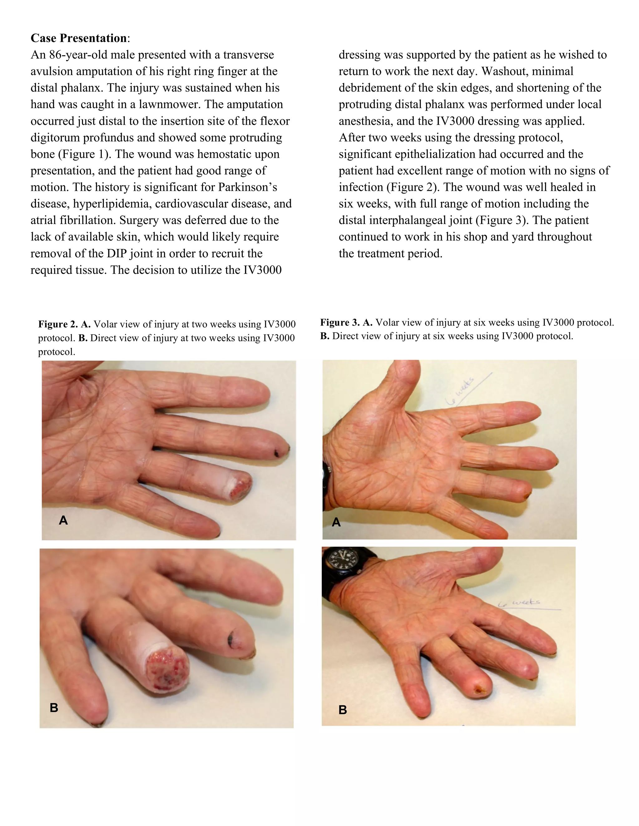 IV 3000: An Innovative Fingertip Dressing | PDF