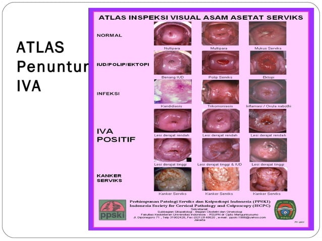 Skrining kanker cerviks dengan IVA | PPT