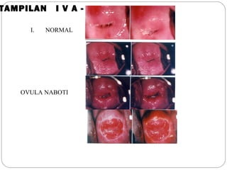 Skrining kanker cerviks dengan IVA | PPT