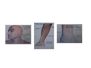 Iv access | PPT
