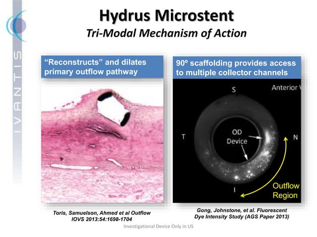 Anterior Segment Company Showcase - Ivantis | PPTX