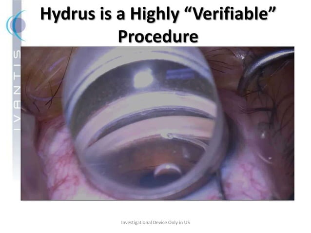 Anterior Segment Company Showcase - Ivantis | PPTX