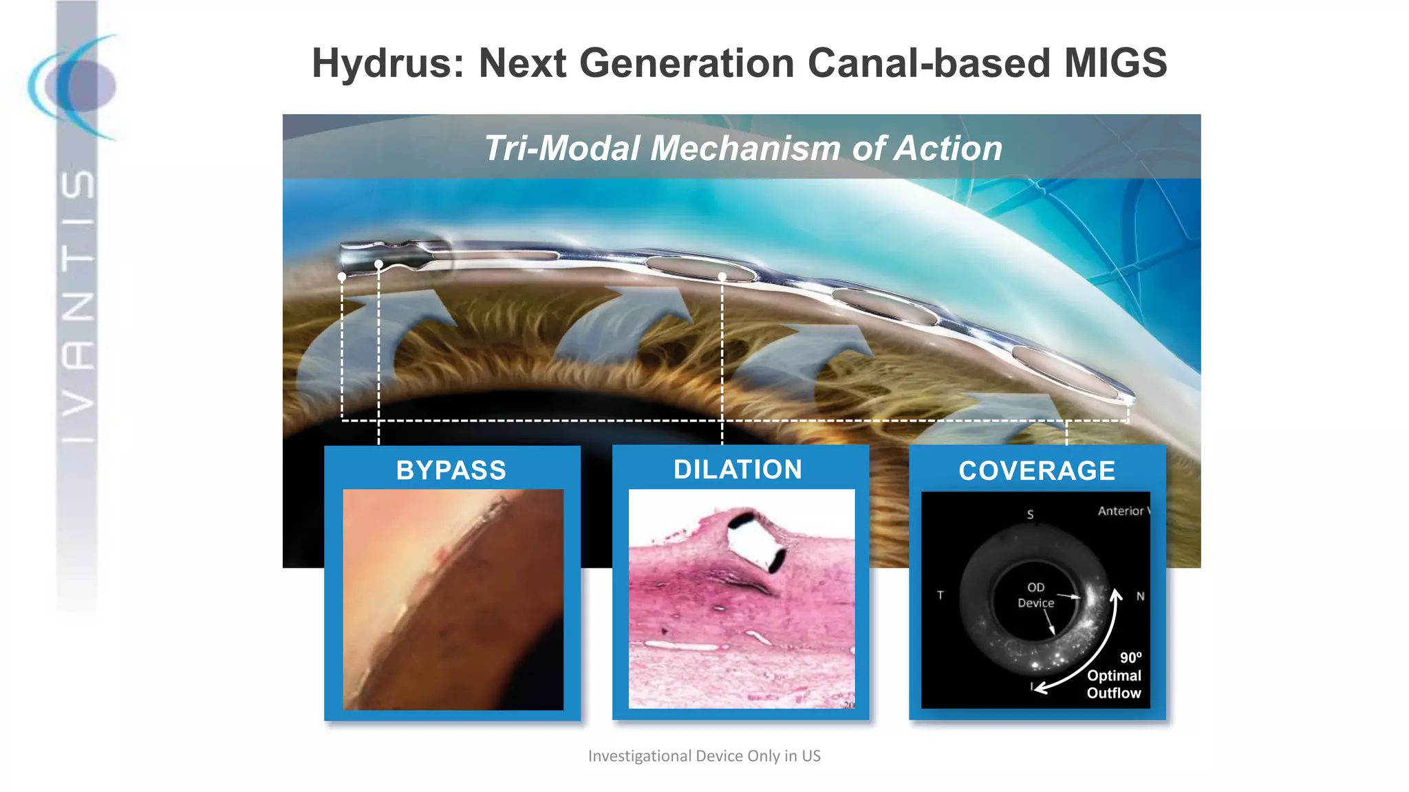 Ophthalmology Innovation Showcase 1 - Ivantis | PDF