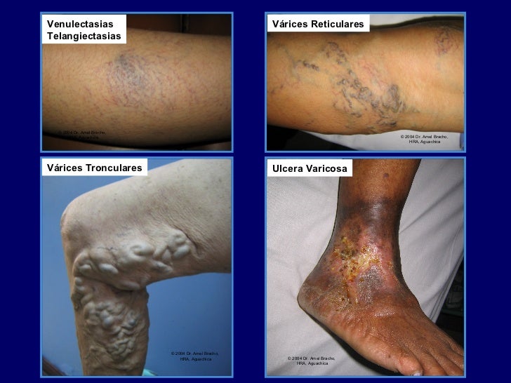 Telangiectasias Pictures Photos