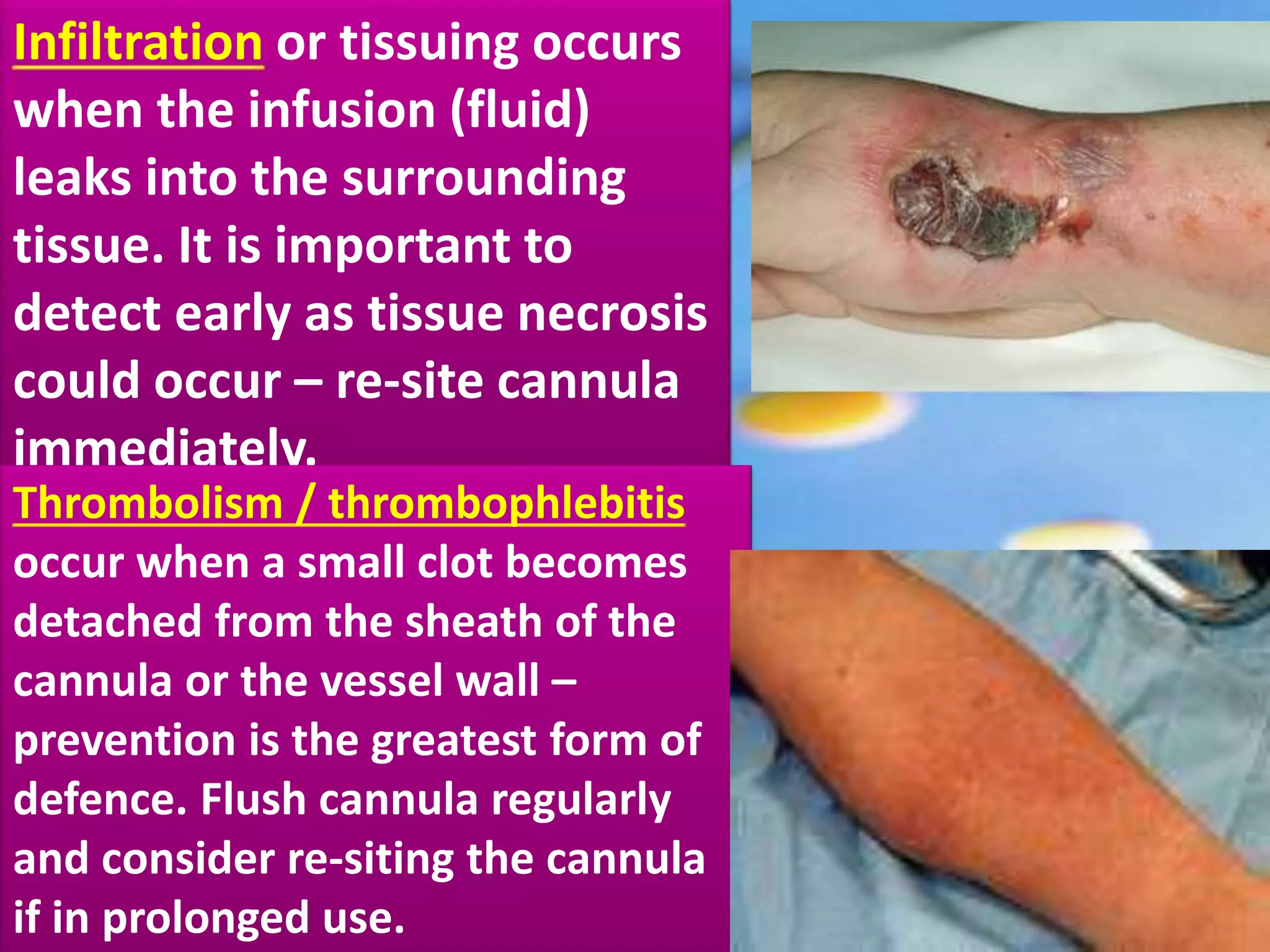 IV CANNULA INSERTION | PPTX
