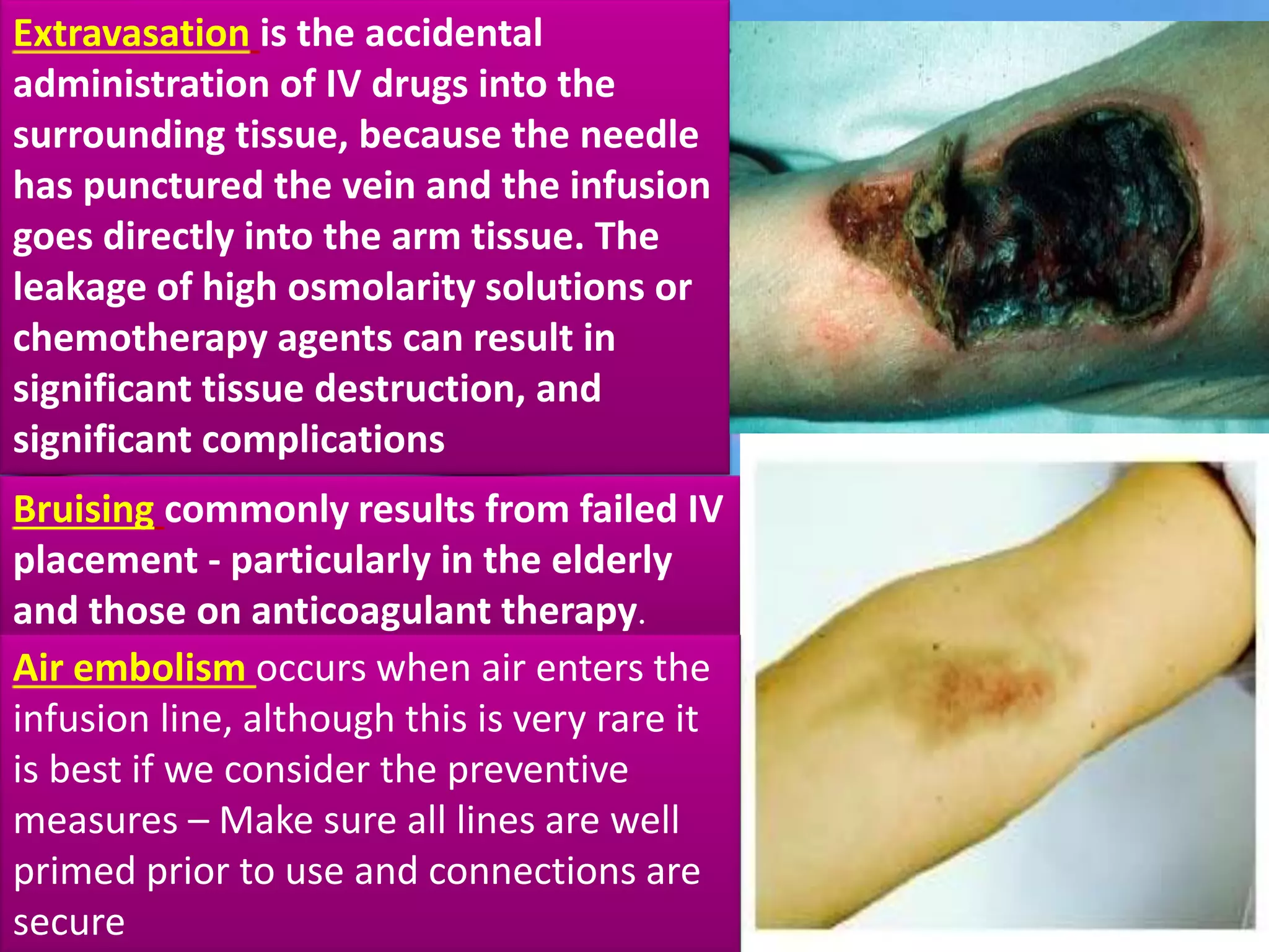 IV CANNULA INSERTION | PPTX