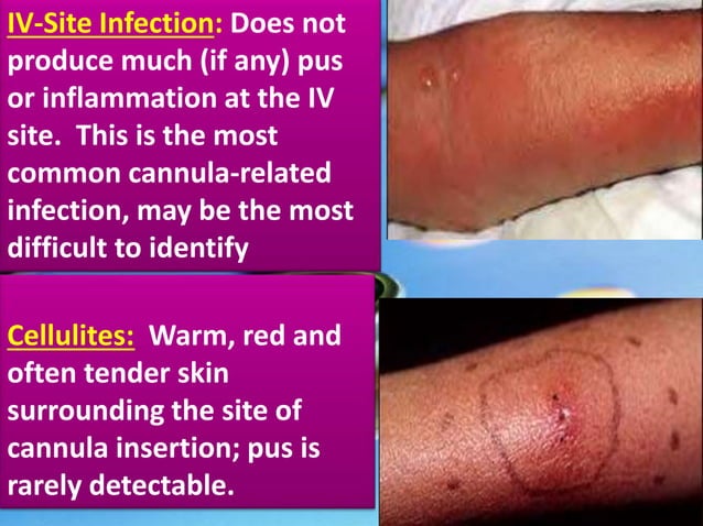 IV CANNULA INSERTION | PPTX | First Aid | Injuries