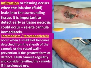 IV CANNULA INSERTION | PPTX
