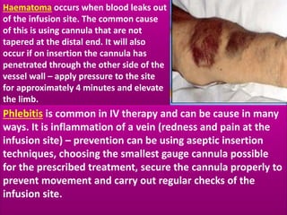 IV CANNULA INSERTION | PPTX