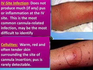 Iv Infection