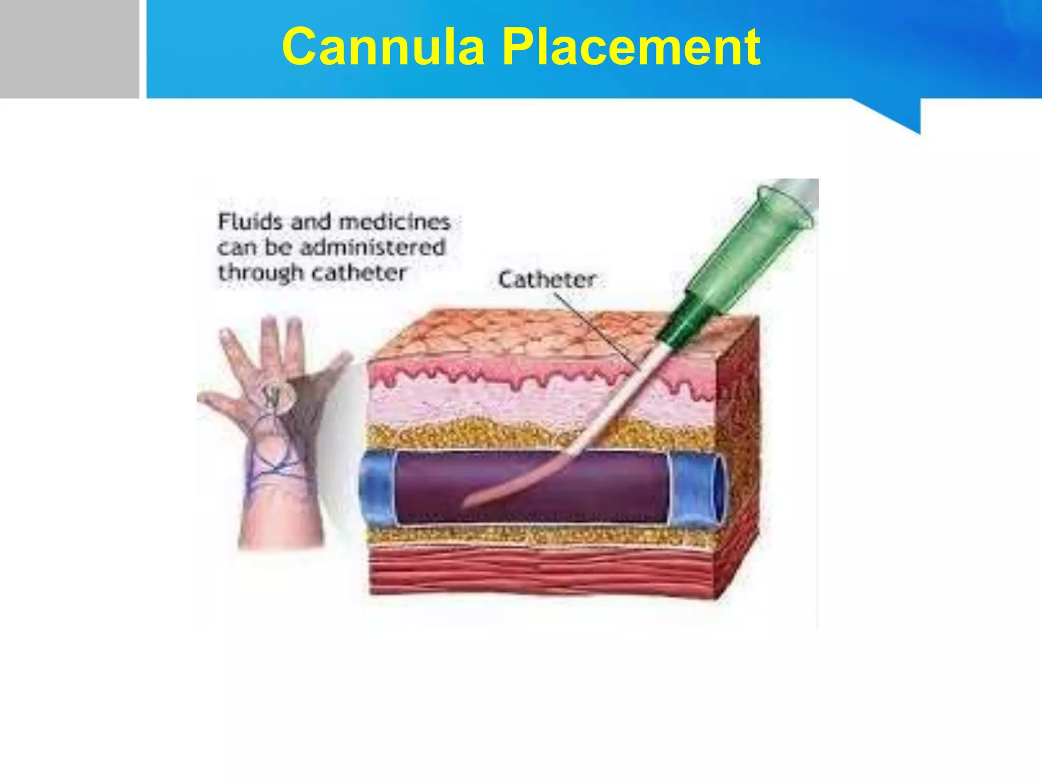 IV Cannulation.ppt