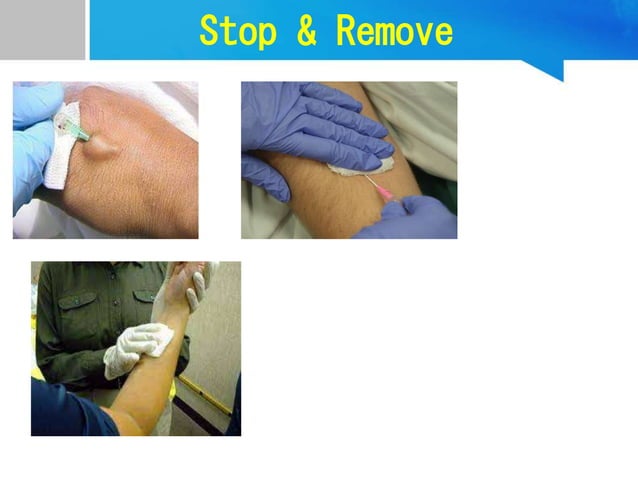 IV Cannulation.ppt | First Aid | Injuries