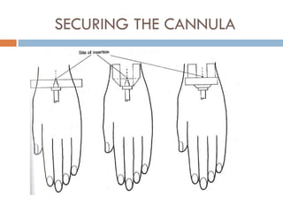 IV cannulation 2012.ppt for information and procedure on iv | PPT