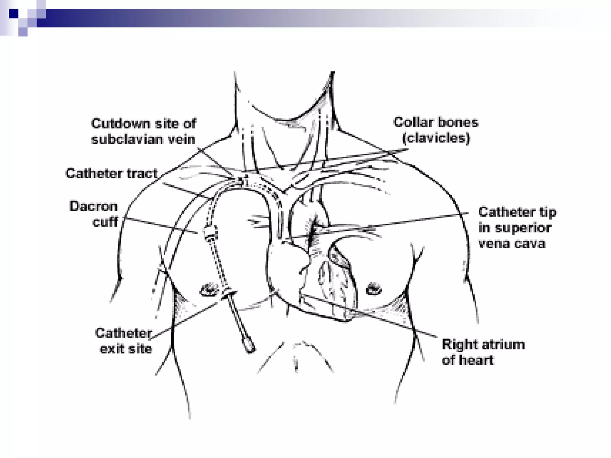 iv_catheter.ppt