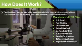 IVC Filter: A Clot Of Injuries & Lawsuits | Mass Torts Device - Neural ...