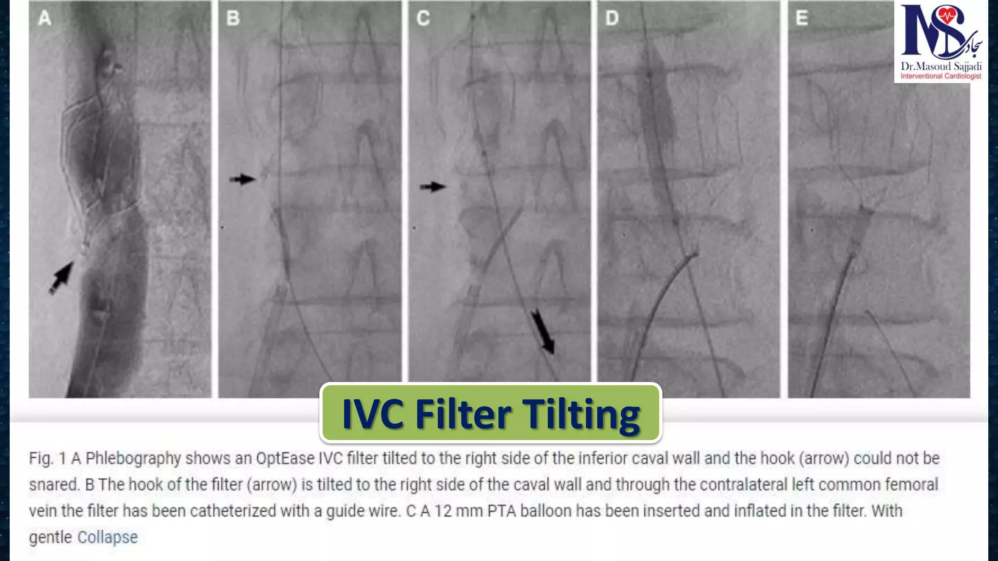 IVC Filter | PDF