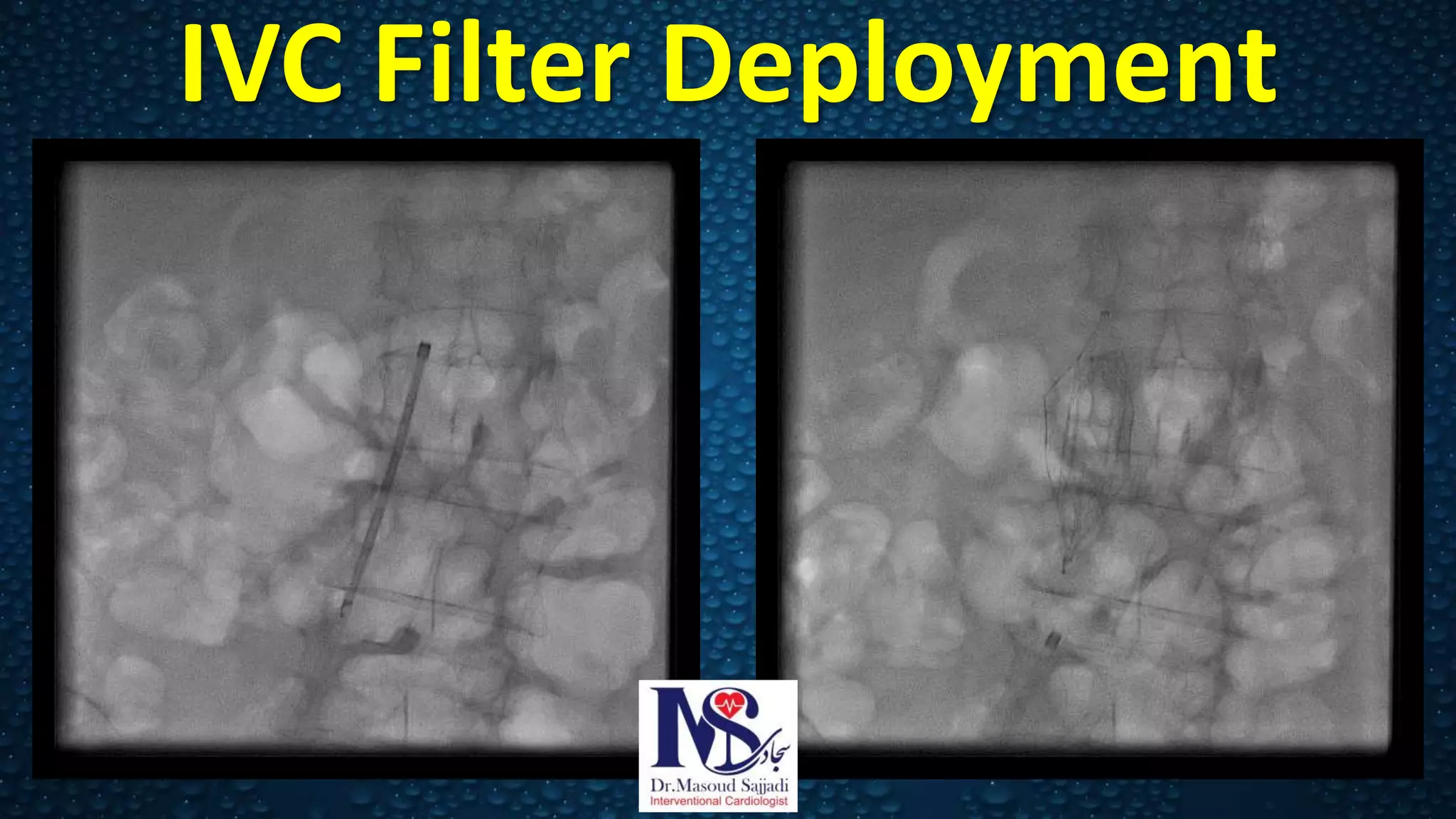 IVC Filter | PDF
