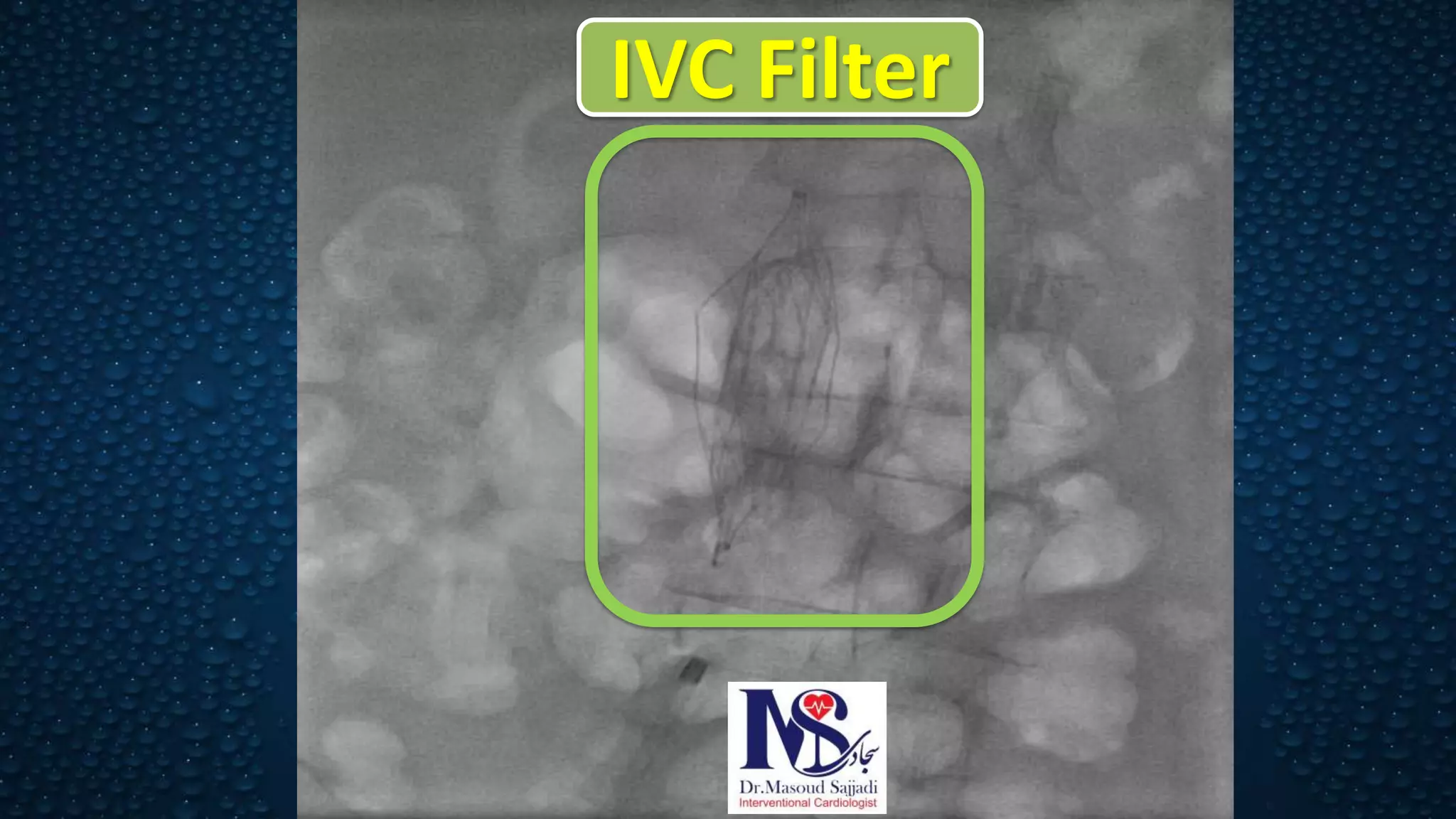 IVC Filter | PDF