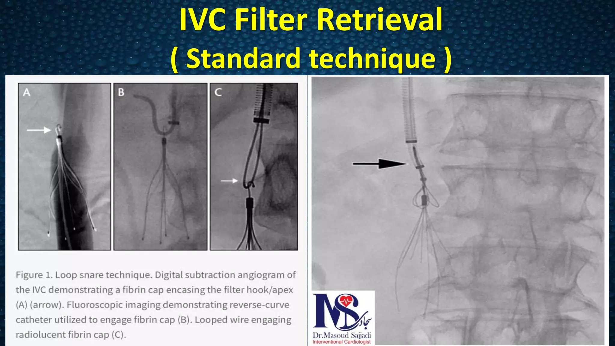 IVC Filter | PDF