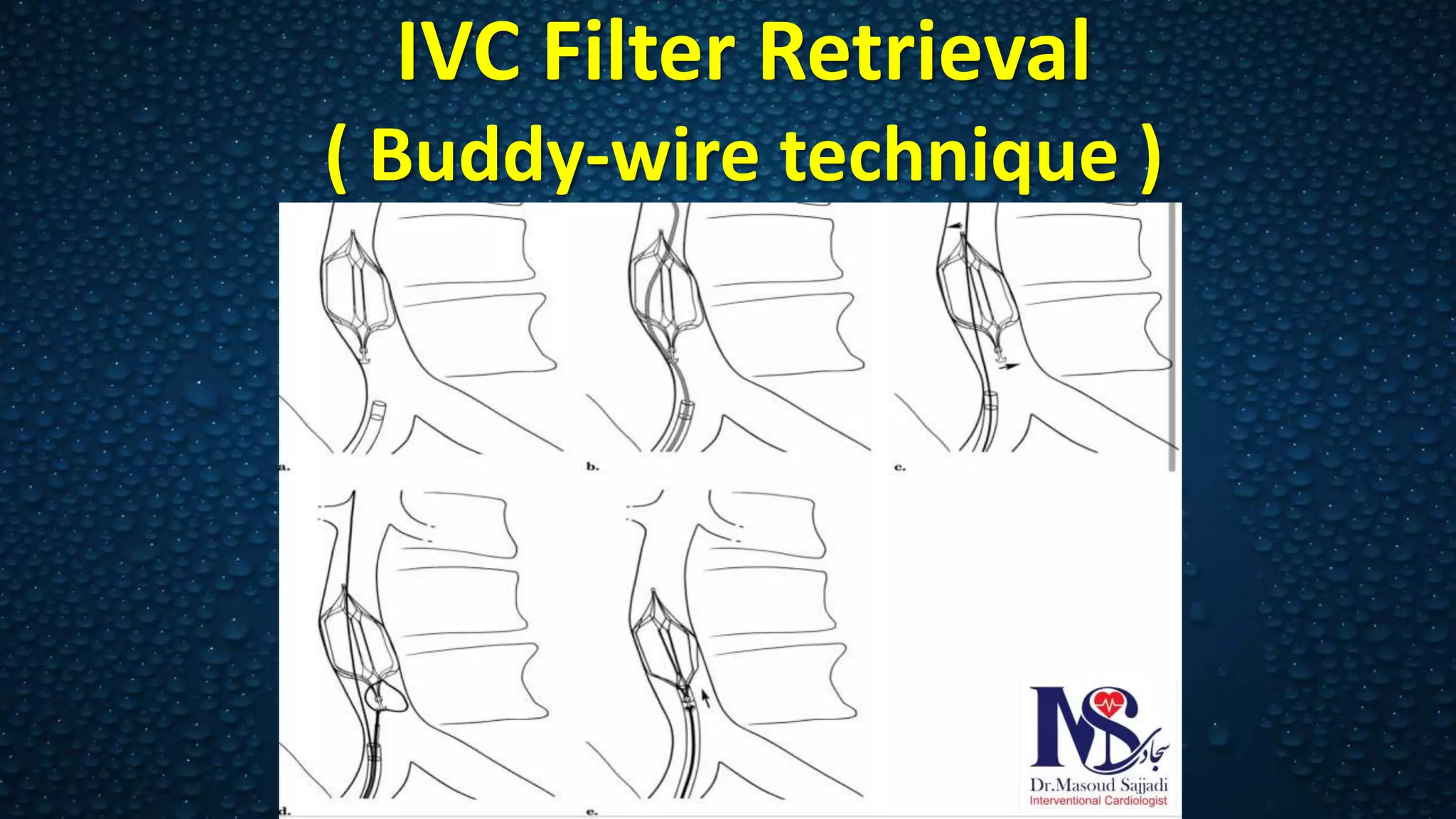 IVC Filter | PDF