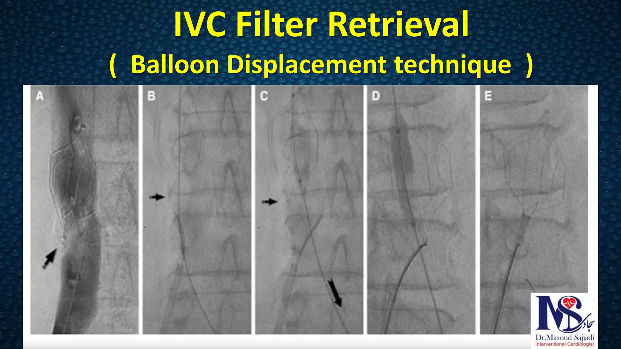 IVC Filter | PDF