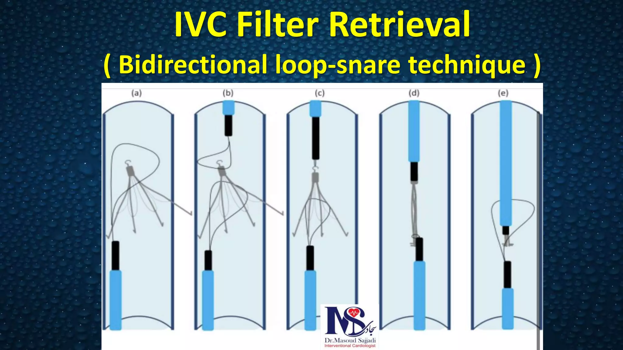 IVC Filter | PDF
