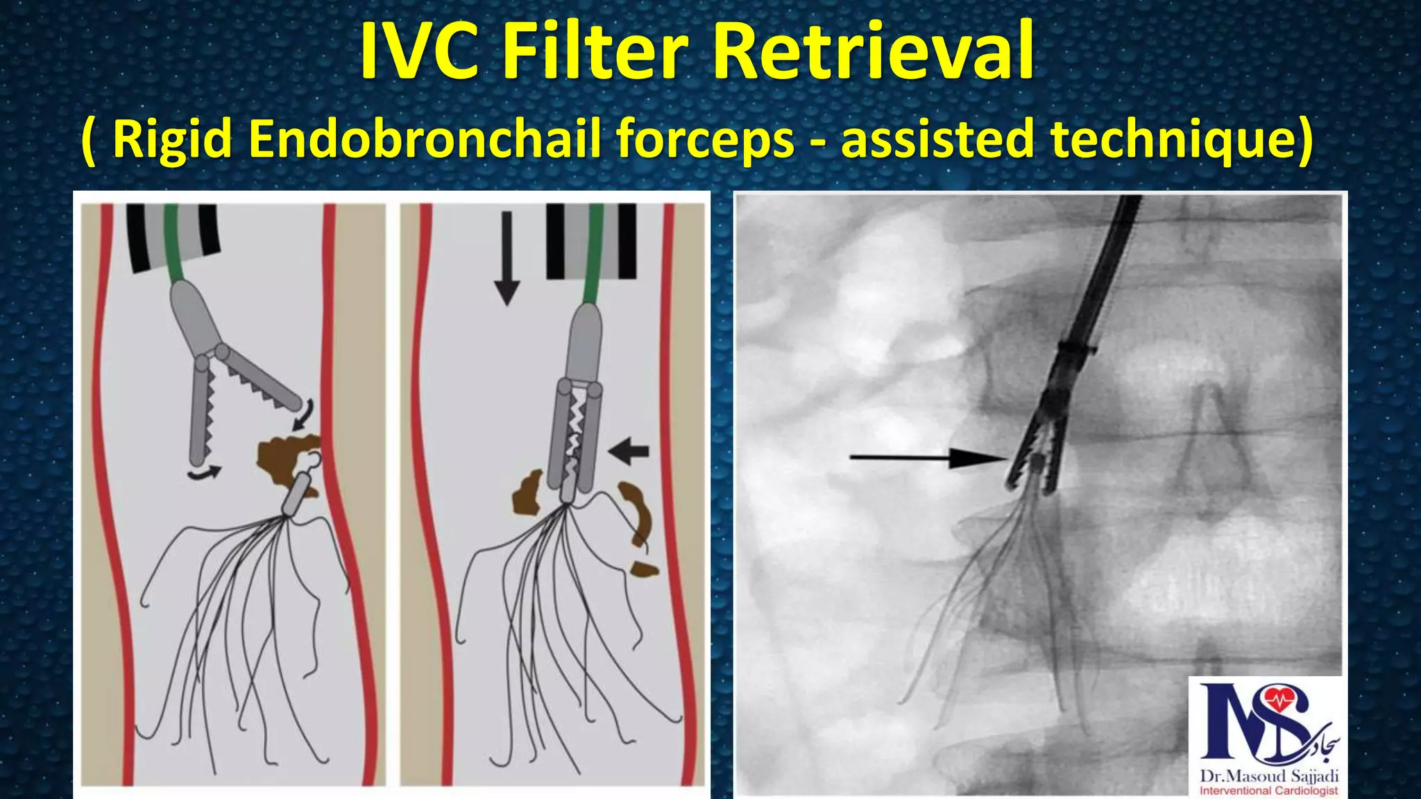 Ivc Filter Pdf