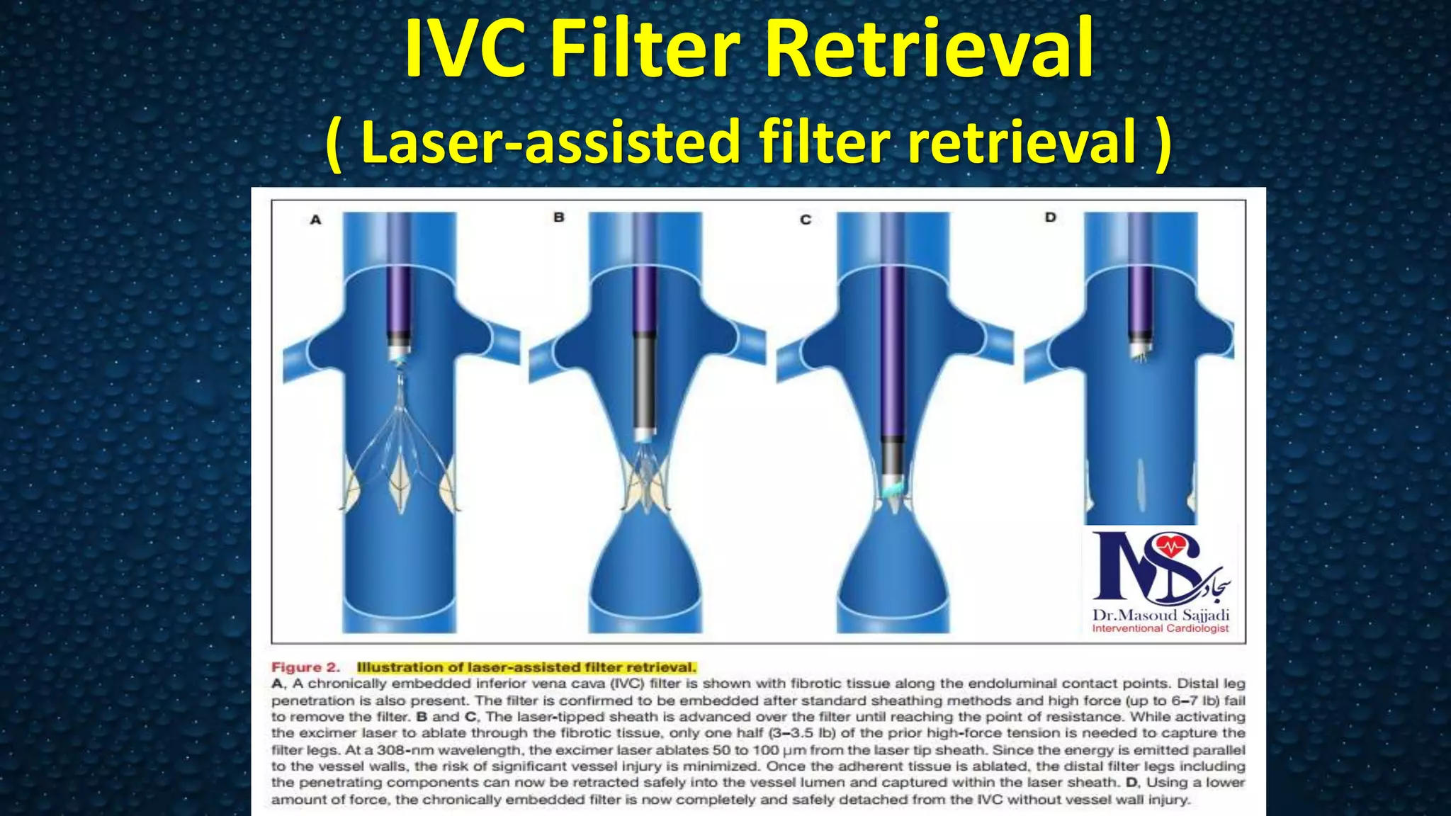 IVC Filter | PDF