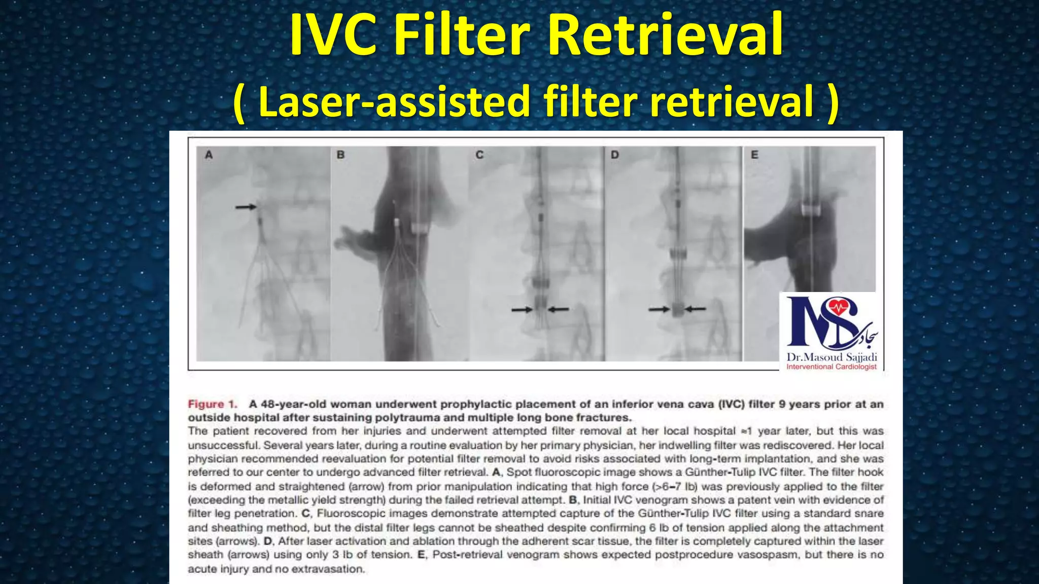 IVC Filter | PDF