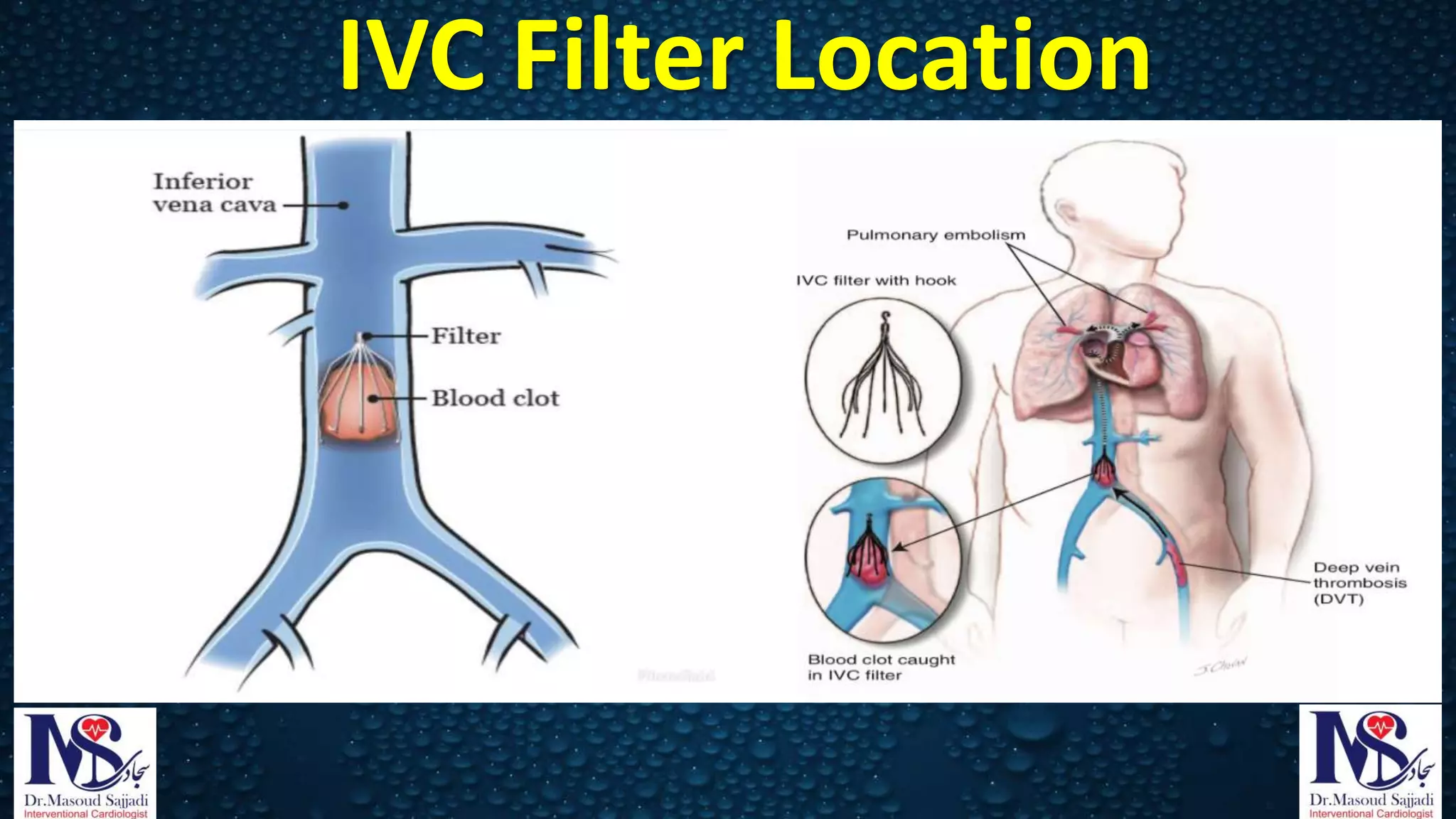 Ivc Filter Pdf