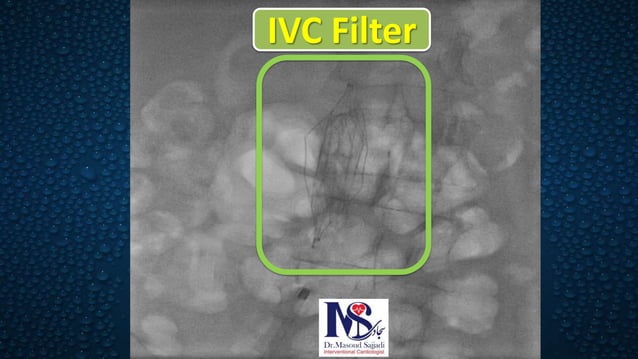 IVC Filter | PDF