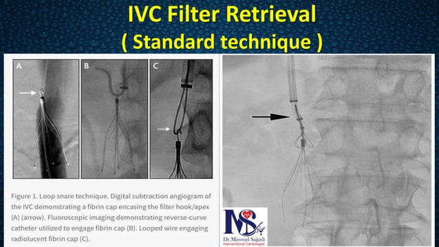 IVC Filter | PDF