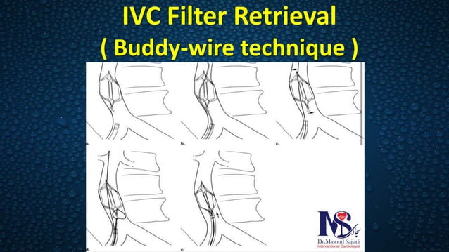 IVC Filter | PDF