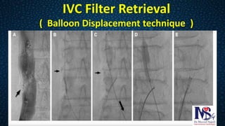 IVC Filter | PDF