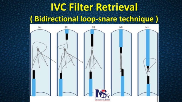 IVC Filter | PDF