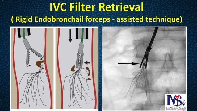 IVC Filter | PDF