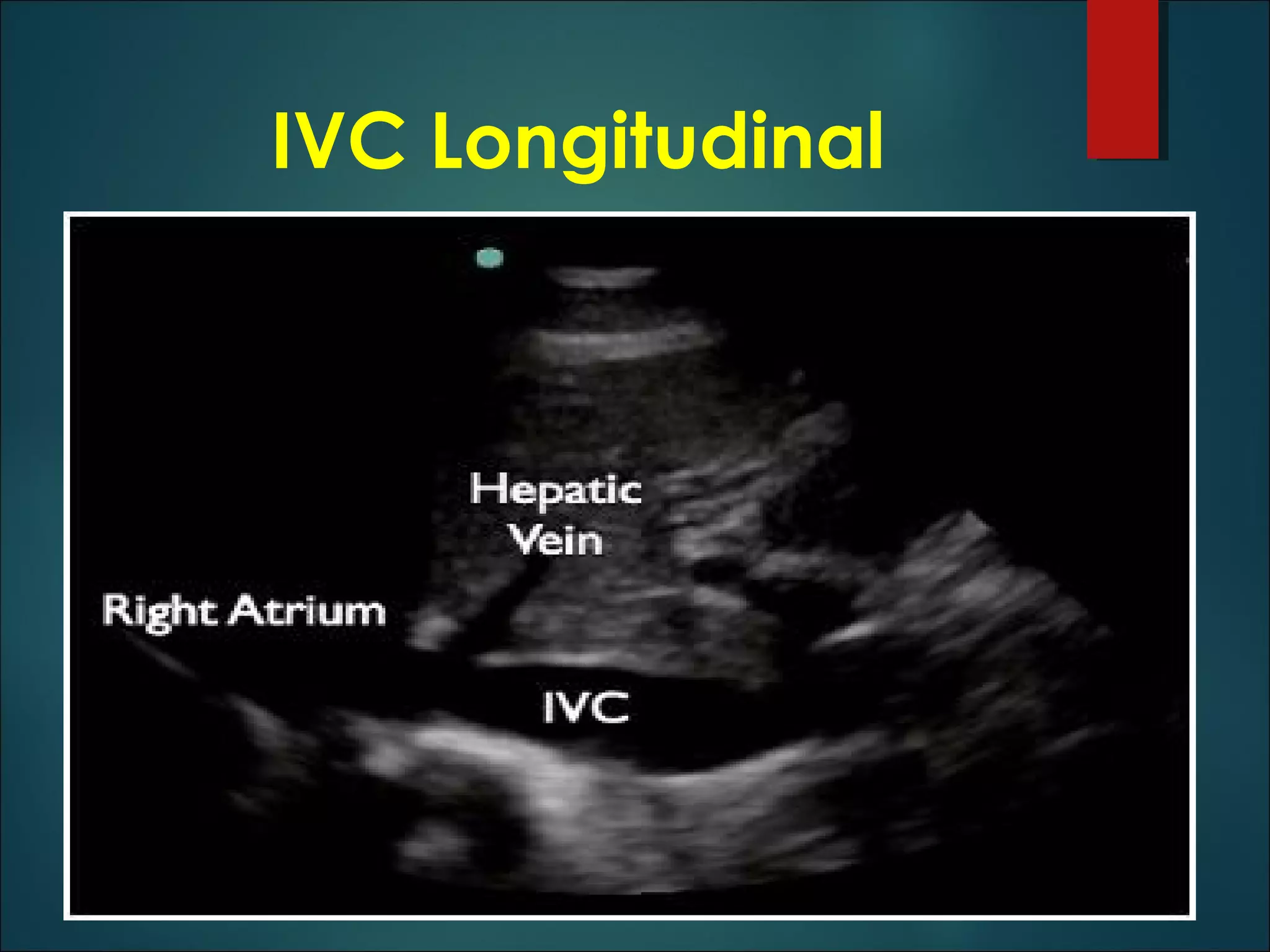 Ivc guided fluid management in the icu | PPT