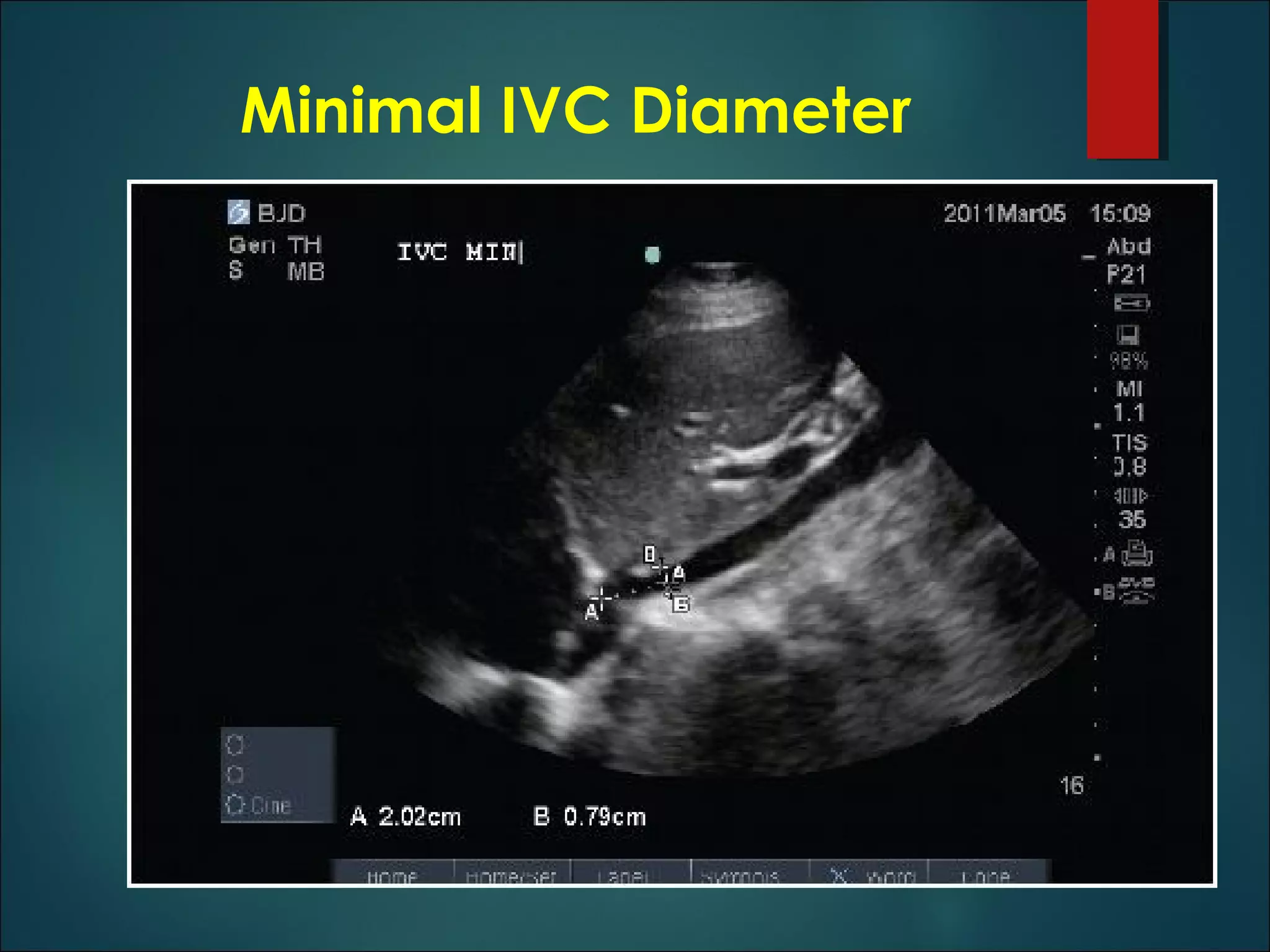 Ivc guided fluid management in the icu | PPT