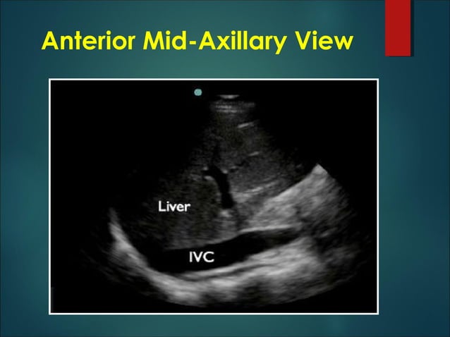 Ivc guided fluid management in the icu | PPT