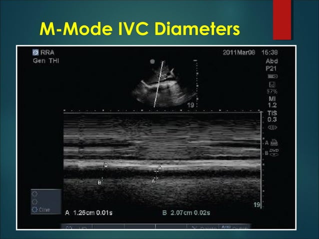 Ivc guided fluid management in the icu | PPT