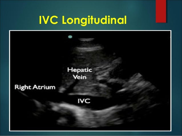 Ivc guided fluid management in the icu