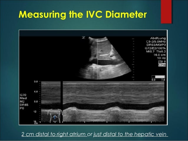 Ivc guided fluid management in the icu