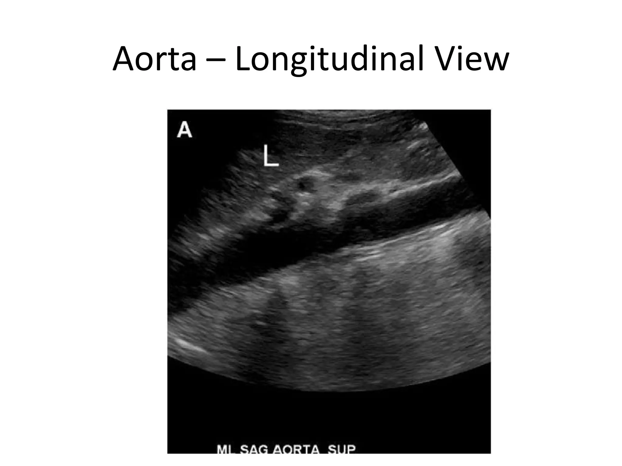 IVC Ultrasound | PPTX
