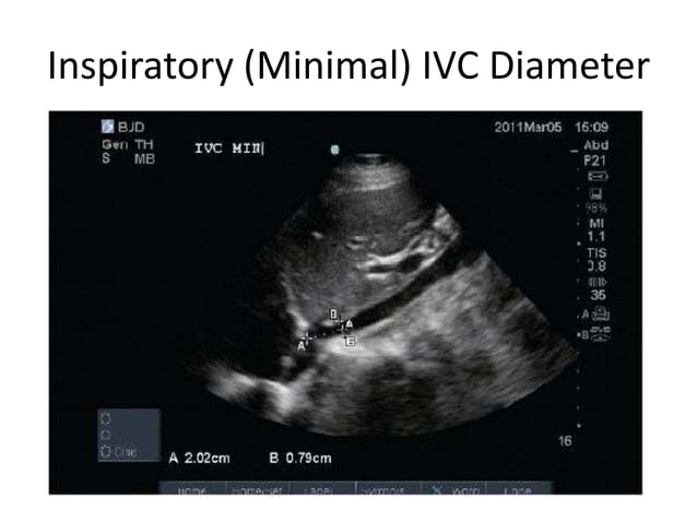 IVC Ultrasound | PPTX
