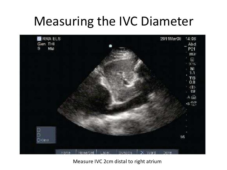 IVC Ultrasound