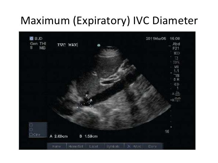 IVC Ultrasound