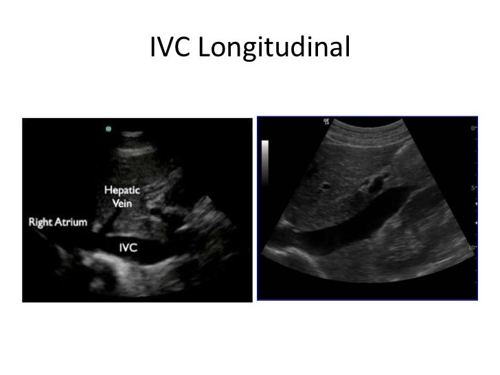 IVC Ultrasound