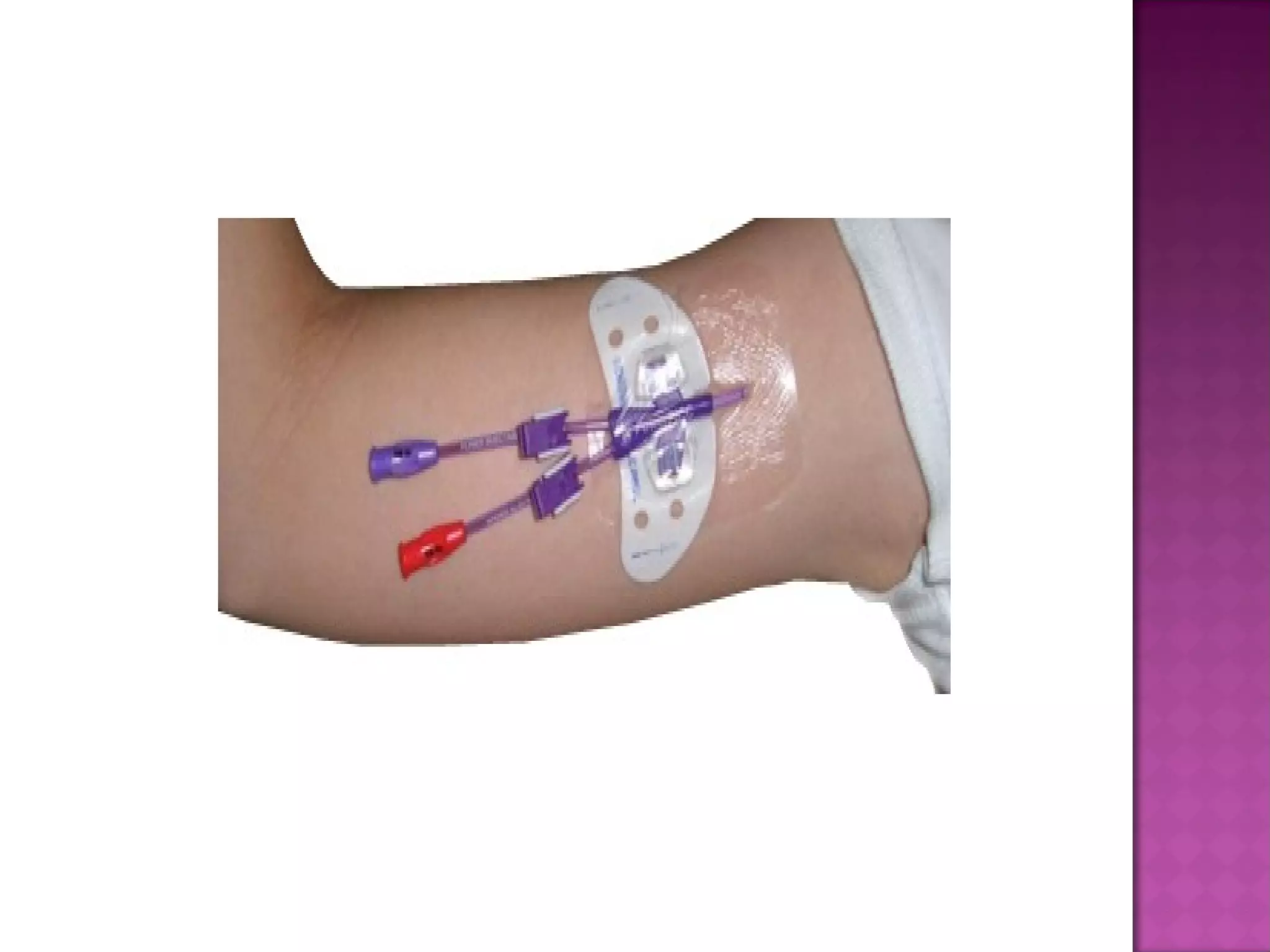 Iv delivery system | PPT