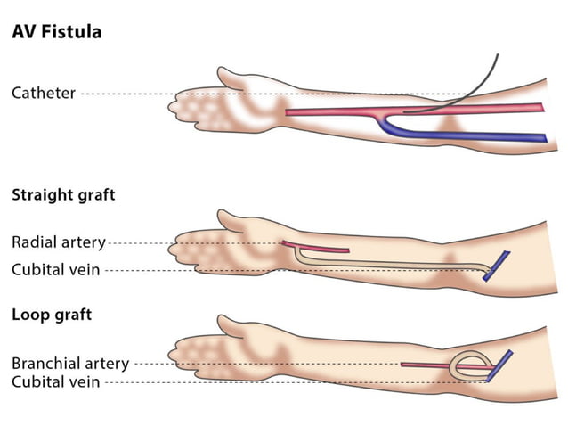 Iv delivery system | PPT